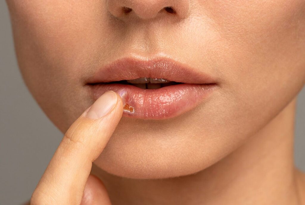 Ferida na Boca? Pode Ser Mucocele